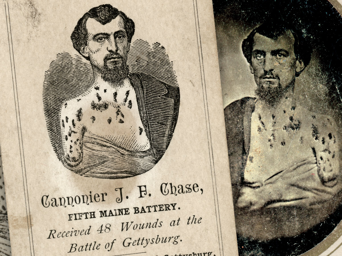 7 Union soldiers at Gettysburg who suffered arms amputation.